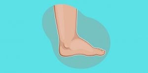 What Are Cankles and Tips on How to Get Rid of Them