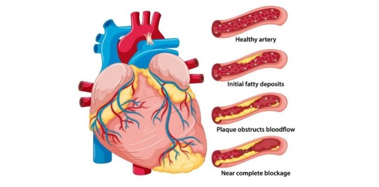5 Foods That Are The Causes of Clogged Arteries And Lead to Heart Disease