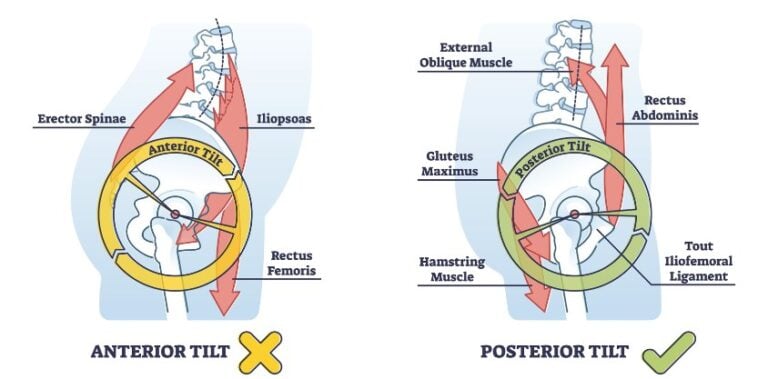 5 Exercises to Correct Correct an Anterior Pelvic Tilt to Release Back ...